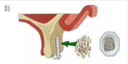 Knochenaufbau Braunschweig - Implantologie Zahnarzt Dr. Rüffert